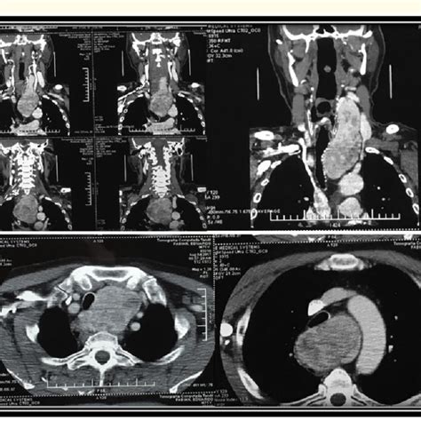 Ct Scan Demonstrating Retrosternal Extension Of Thyroid Mass In A