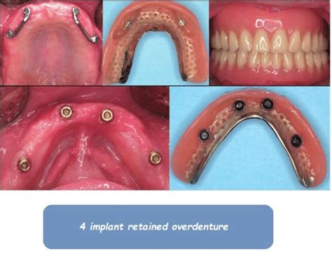 4 Implant Retained Overdenture