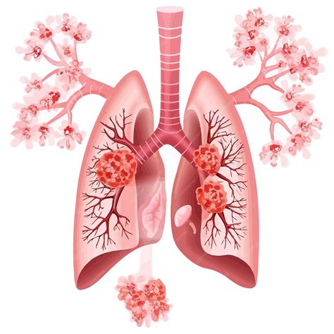 Premium Vector Lung Cancer Diagram In Details Vector