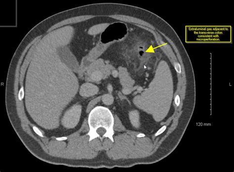 What To Do In Case Of Diverticulitis Flare Up Design Talk