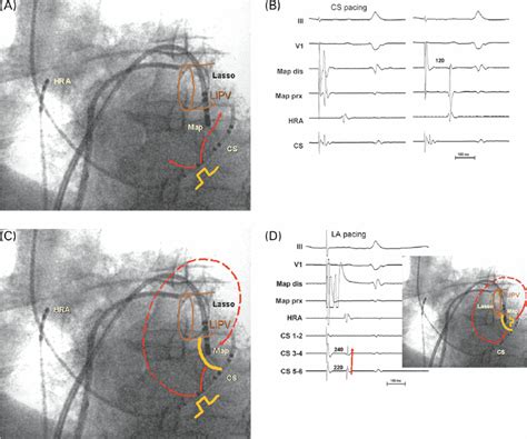 Conduction Block Of The La Isthmus Prior To The Ablation Conduction