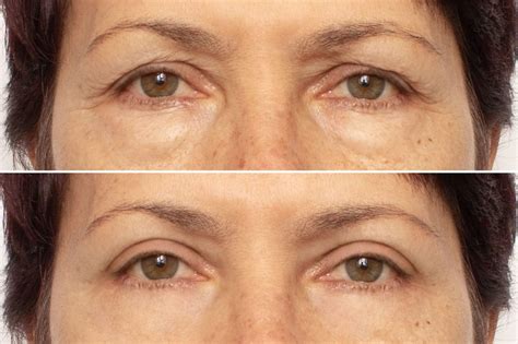 Dermatochalasis Vision For Life Institute