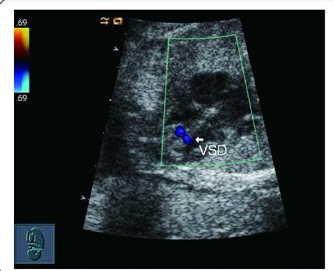 Color Doppler Echocardiographic Examination Of Small Vsd Download