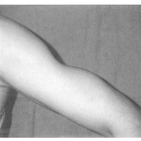 Lipoatrophic Area In The Left Arm Download Scientific Diagram