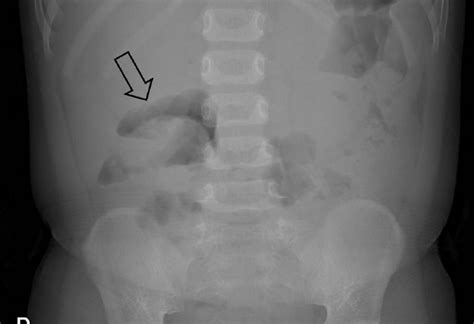 Intussusception X Ray