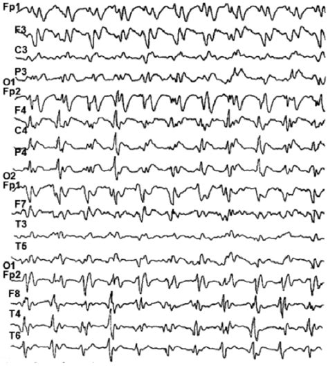 Periodic Sharp Waves At About 15sec Diffuse Bilateral Slightly Download Scientific Diagram