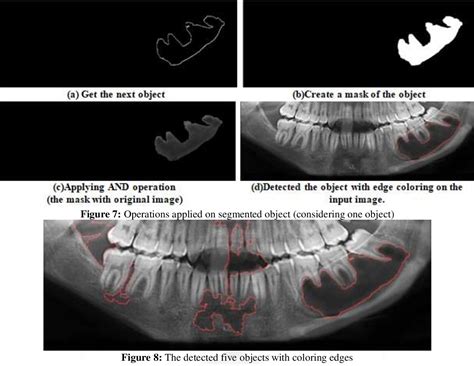 Figure 7 From Opg Images Automatic Segmentation And Feature Extraction For Dental Lesion