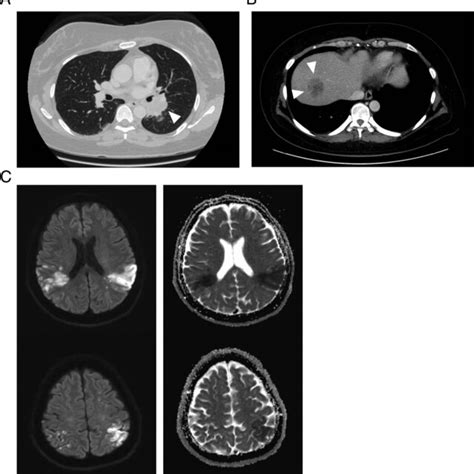 Clinical Course Of Case 1 A Computed Tomography Scan At The Time Of
