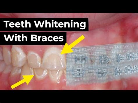 How To Whiten Teeth That Have Braces
