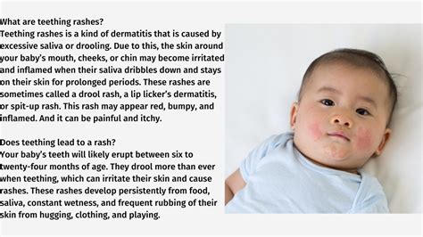 Ppt Here Is What You Need To Know About Teething Rashes Powerpoint