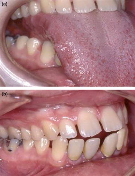 Macroglossia Pmc