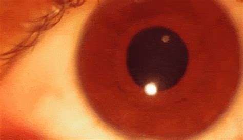 Hippus Also Known As Pupillary Athetosis Is Spasmodic Grepmed