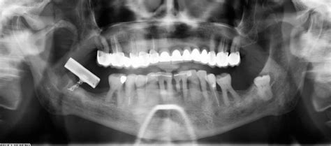 decompression of mandibular odontogenic keratocyst using a custom drain
