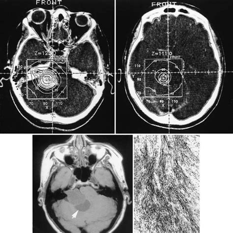 Upper Stereotactic Ct Scans Obtained Using The Double Window Technique