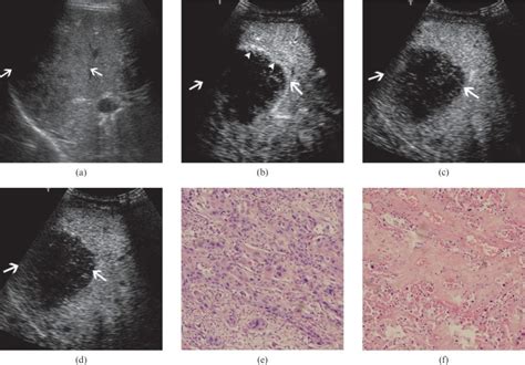 Contrast Enhanced Ultrasound Of Intrahepatic Cholangiocarcinoma Correlation With Pathological