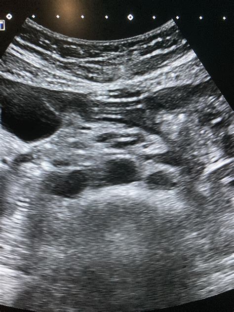 Duplicated Infrarenal Ivc On U S The Left Ivc Drains Into The Renal