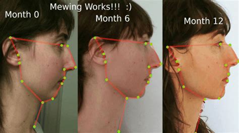 Chewing Gum For A Defined Jawline Benefits And Expert Tips