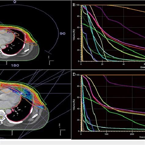 Vmat Plan A And Dvh B Imrt Plan C And Dvh D Abbreviation Download Scientific Diagram