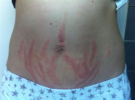 Laser Stretch Mark Removal 4 Out Of 5 Dentists Recommend This