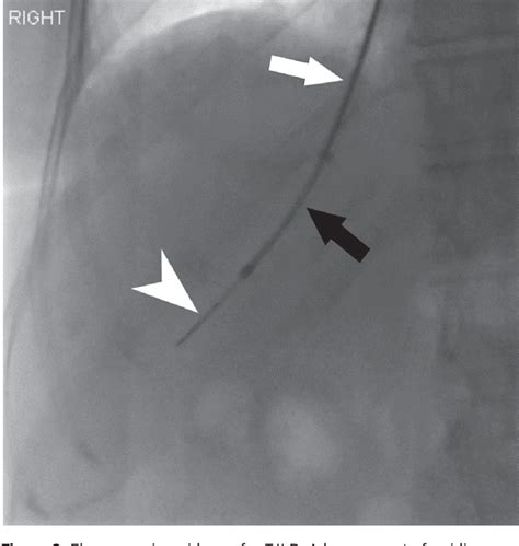 Pdf Percutaneous And Transvenous Liver Biopsy Semantic Scholar