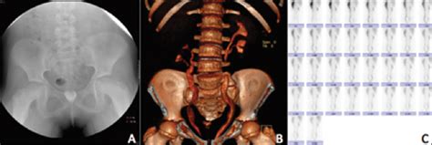 A Voiding Cystouretrography Bladder Absence B Computed Tomography Download Scientific