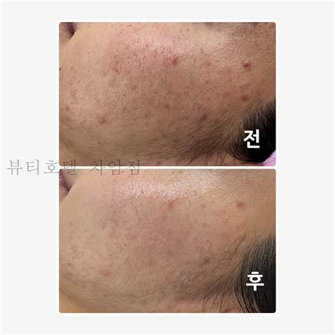 📍지성체질의 여드름관리 ⠀⠀⠀⠀⠀⠀⠀ ⠀⠀⠀⠀⠀⠀⠀ 고객님은 지성타입의 체질이셨고 평소 물로만 아침 저녁 세안 하시고 홈케어는 이니 스킨 세럼 크림 바르셨다