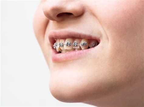 Orthodontic Dental Braces On Teeth Of Upper Jaw Stock Image Image Of Dentistry Closeup 222330397