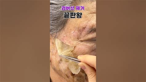 피부 검버섯이 고민이라면 일산리팟 일산피부과 일산흑자 일산오타양모반 삼송동리팟 행신동피부과 식사동흑자 행신동리팟 Youtube