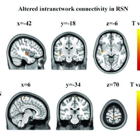 Brain Regions Showing Between Group Significant Differences In