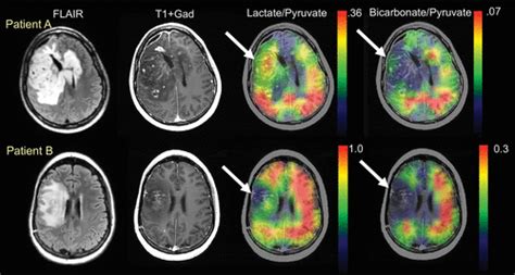 Hyperpolarized 13c Mri State Of The Art And Future Directions Radiology