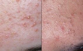 Std On Face Pictures