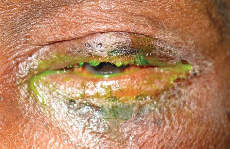 Mix Of Pathogens Cause Acute Infectious Conjunctivitis