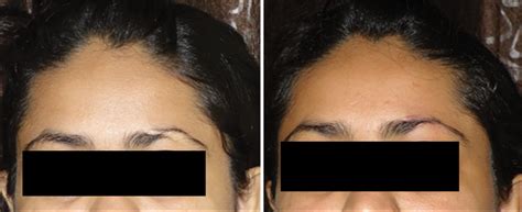 Eyebrow Reconstruction By Simple Elliptical Excision With Beveled Incision A Case Series Of