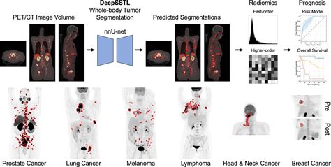 Deep Semisupervised Transfer Learning For Fully Automated Whole Body Tumor Quantification And