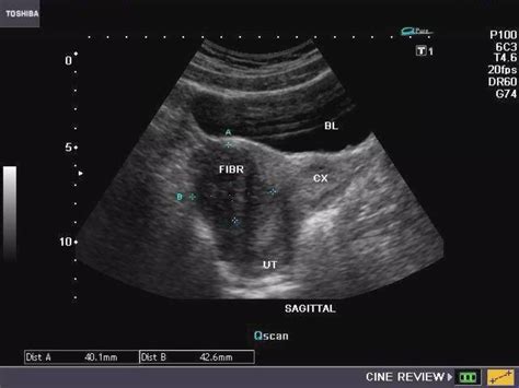 Uterine Fibroids On Ultrasound Pptx