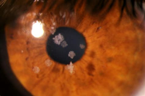 Recognising Corneal Dystrophies Mivision
