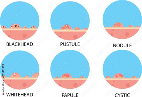 Vector Collection Of Types Of Pimples Inside The Skin Facial Infections Pimples And Skin