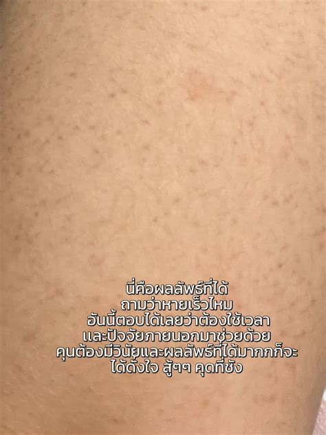 เจาะลึกการดูเเลขนคุด ประสบการณ์ใช้จริง ใช้ดีจึงบอกต่อ แกลเลอรีที่