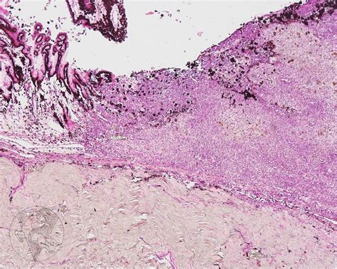 Diffuse Iris Melanoma Cat