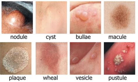 Chapter 8 Skin Diseases And Disorders Flashcards Quizlet
