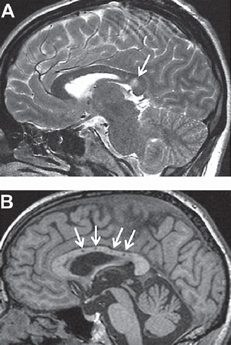 Callosal Pathology In Susac Syndrome Demonstrated By Conventional