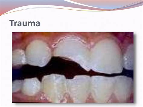 Parallel Angle Technique Vs Bisecting Angle Technique Pptx Dental