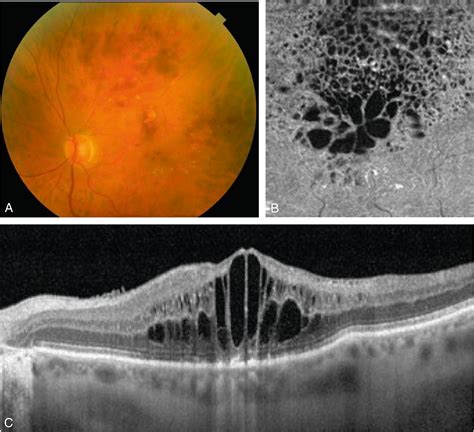 Branch Retinal Vein Occlusion Clinical Tree