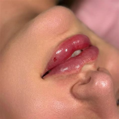 Կատարվել է շուրթերի ծավալի մեծացում👄 ‼️Շտապիր գրանցվել‼️