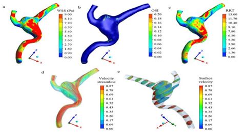 Geometry 3 Giant Saccular Aneurysm In The Ba A Wss B Osi C