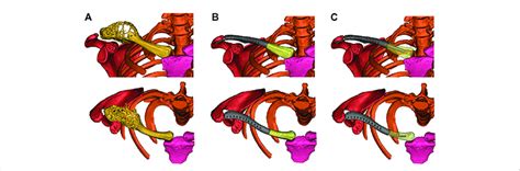A Reconstructed Virtual 3d Tumors And Clavicle Models B The