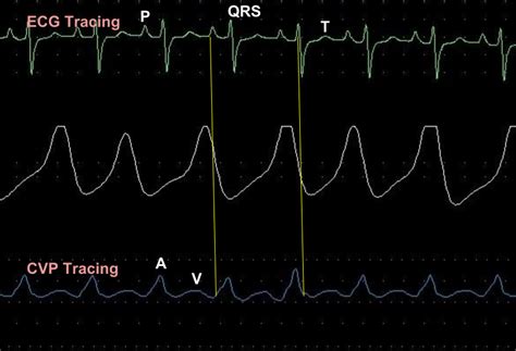 Central Venous Pressure Tracing Cvp Tracing Along With Ecg
