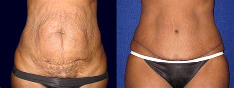 Tummy Tuck Before And After Stretch Marks