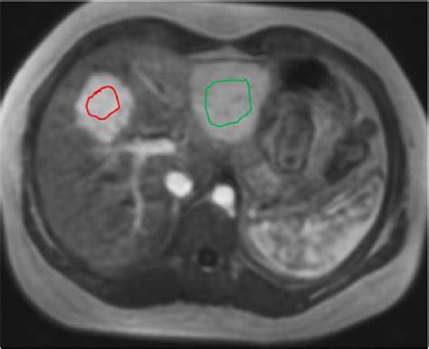 Figure 1 From Focal Nodular Hyperplasia Of The Liver Diffusion And