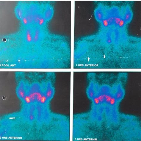 Parathyroid Scintigraphy In Patient With Primary Hyperparathyroidism Download Scientific